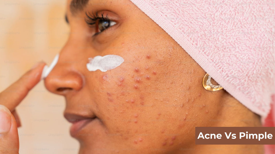 Acne vs Pimples: Key Differences and Why They Matter